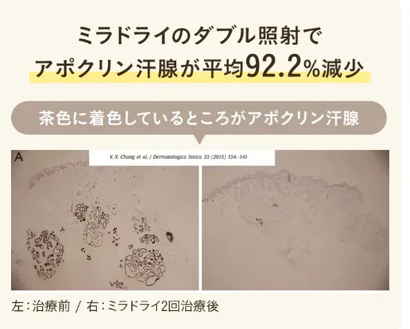 共立美容外科のミラドライのダブル照射とは？金額も徹底調査 – 形成外科・美容整形ならまぶたのクリニック【公式】